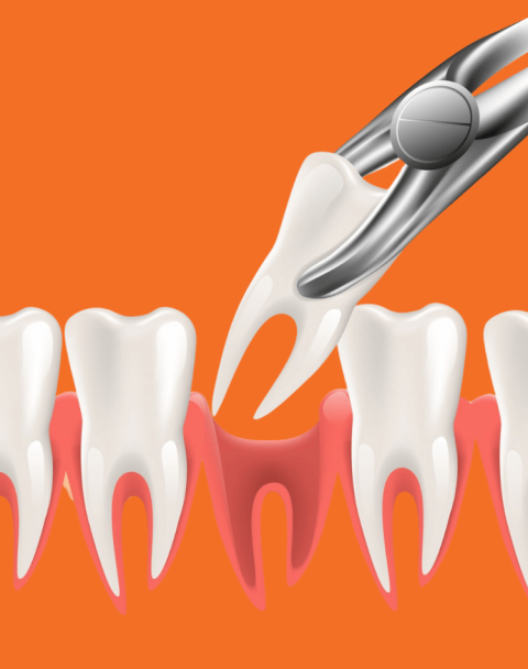 Tooth Extraction - Arrow Dental Centre