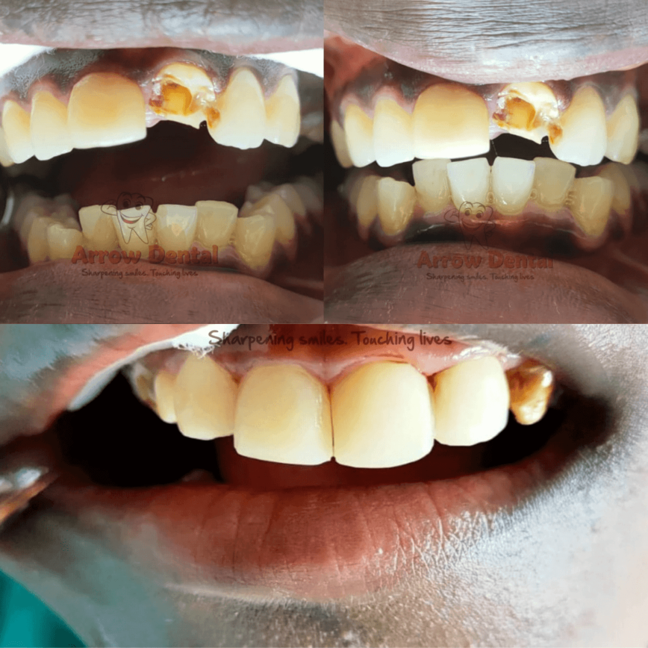 Dental Filling - Arrow Dental Centre