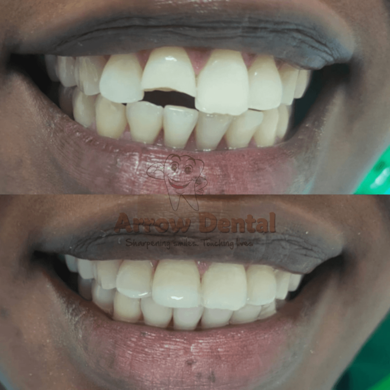 Dental Filling - Arrow Dental Centre