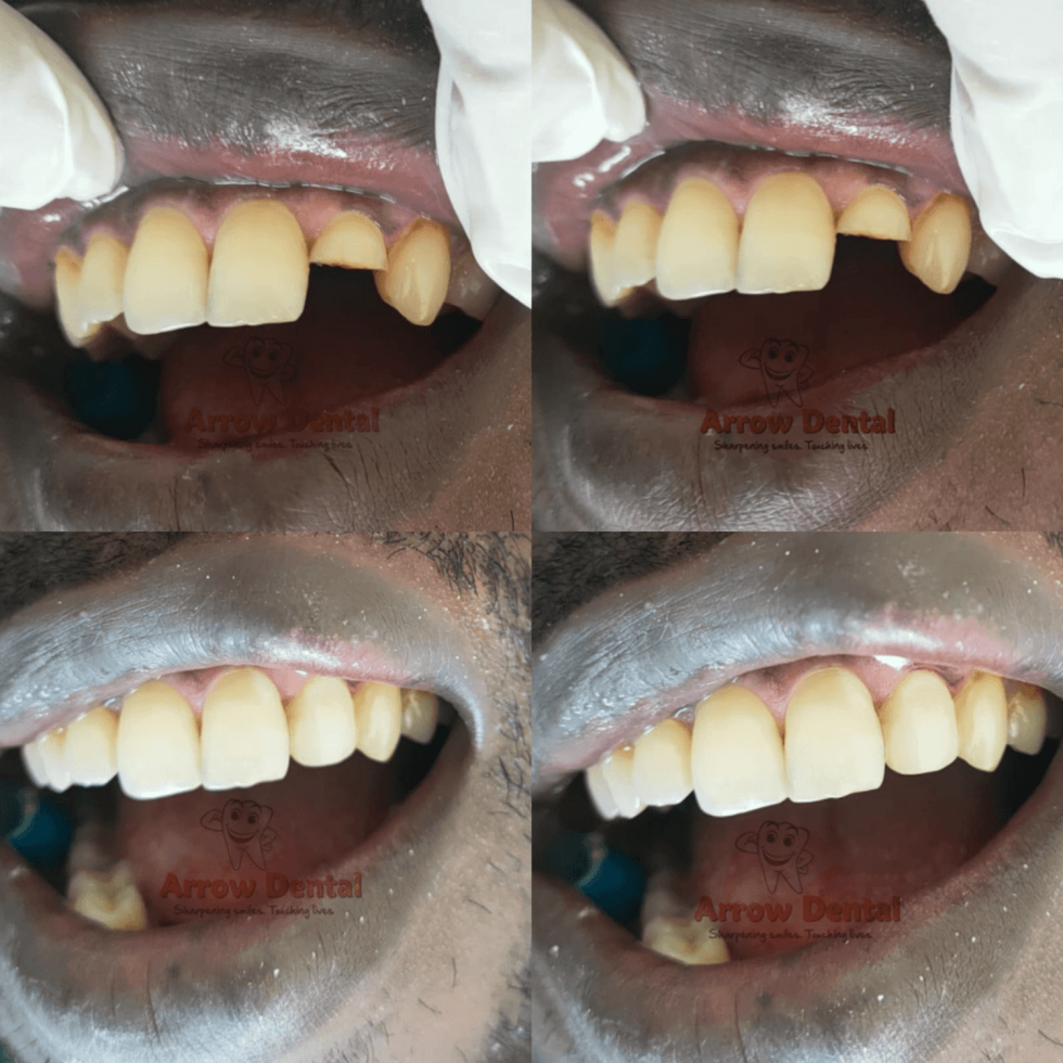 Dental Filling - Arrow Dental Centre