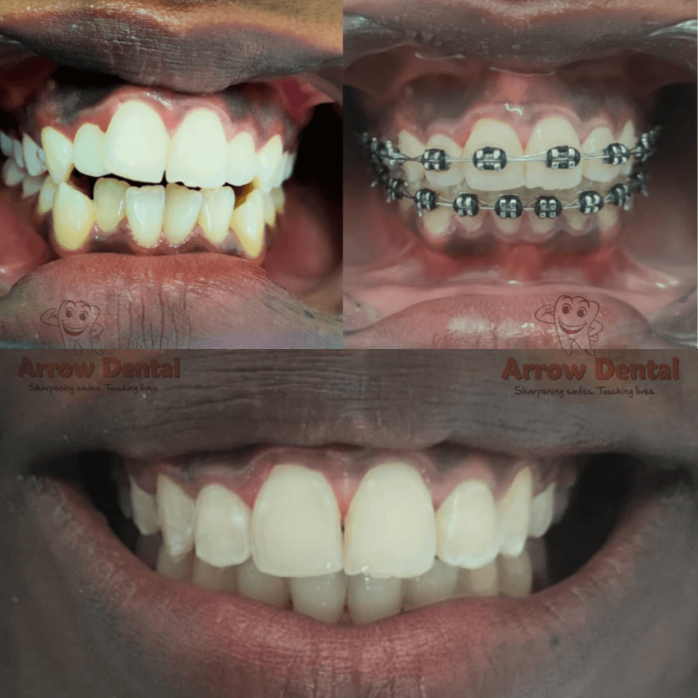 Braces - Arrow Dental Centre