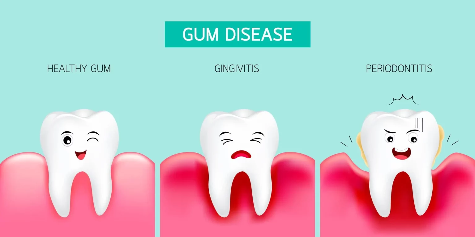 Gum Disease in Kenya: Early Detection and Treatment - Arrow Dental Centre